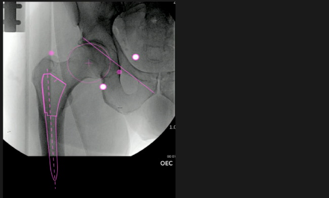Médica Sur: Navegador Velys Hip